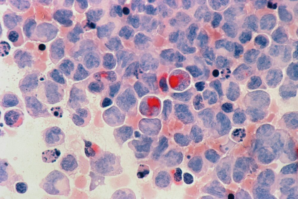 Diffuse Gastric Adenocarcinoma: Management and Treatment